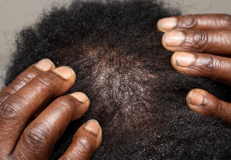 Haarwurzeln von Afrohaaren | Dr. Acar