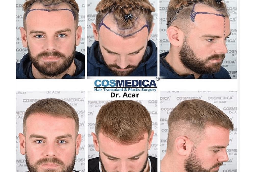 Haartransplantation Türkei Vorher Nachher Dr Acar